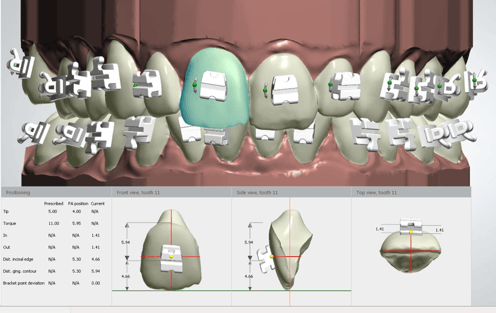 Digital Bracket Setup Now Included with Every Case